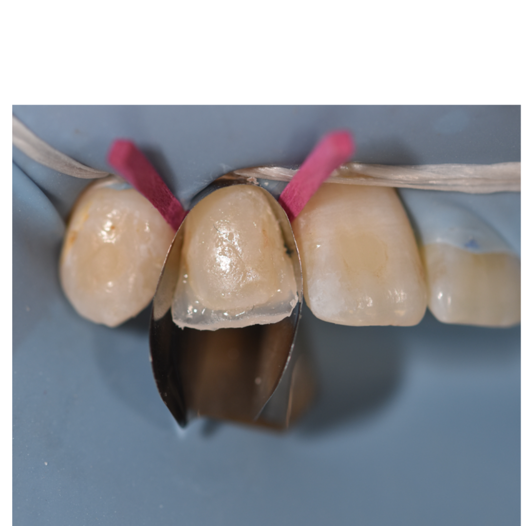 Origin Anterior Twin Matrix – İda Dental Products